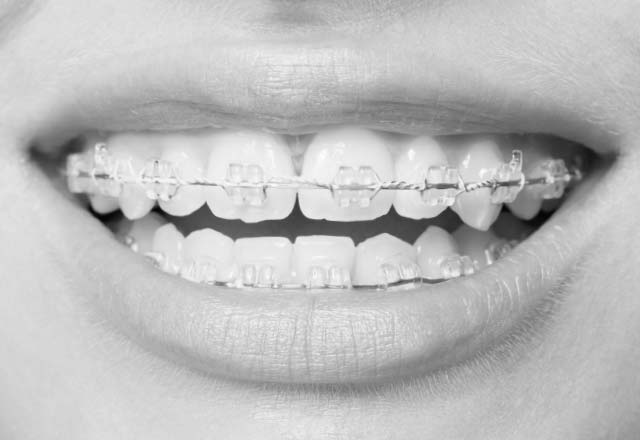 Black And White Braces For Teeth